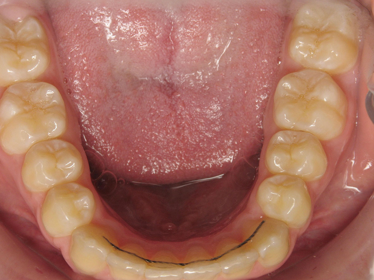 La période de rétention - Dr Tanguay